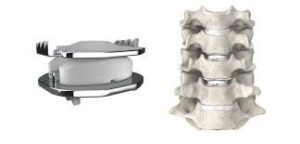 Cervical Disc Replacement Surgery Revision - Princeton Neurological Surgery