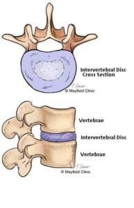 Discogenic Back Pain Morristown NJ - Spine Specialists